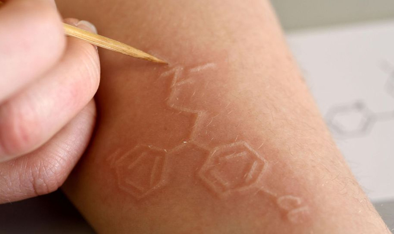 ¿Sabes que es el dermografismo? | LatinOL.com Vida Social